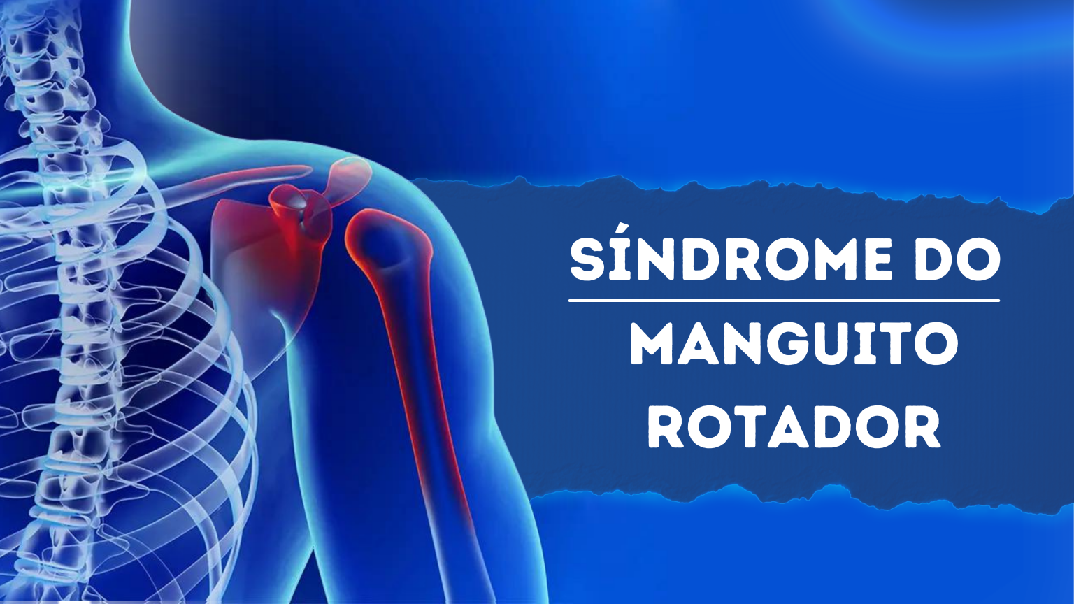 Síndrome do Manguito Rotador é Doença do Trabalho?
